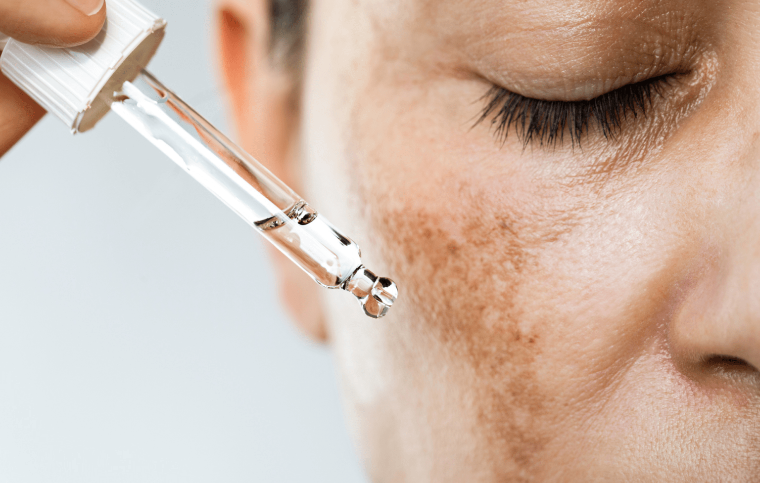 Understanding Melasma: Your Guide to Clearer, Brighter Skin - McKenzies ... Understanding Melasma: Your Guide to Clearer, Brighter Skin - McKenzies ...